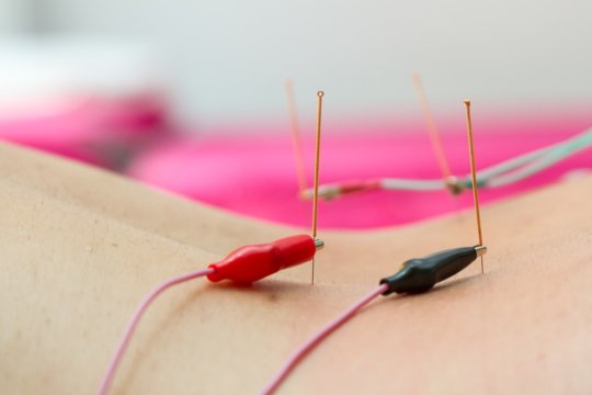 What is Electro-Acupuncture and is it right for you? | Rebalance Sports ...
