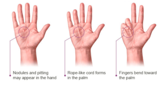 Dupuytren Contracture Causes Symptoms Treatment And Exercises Dupuytren Contracture Causes Symptoms Treatment And Exercises